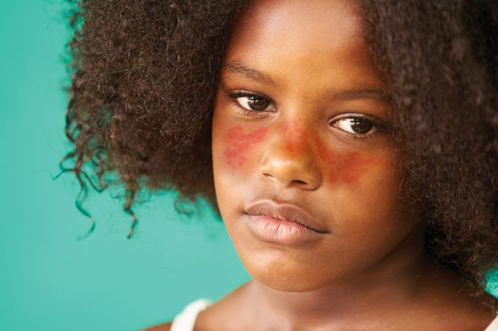 Subacute Cutaneous Lupus In African Americans
